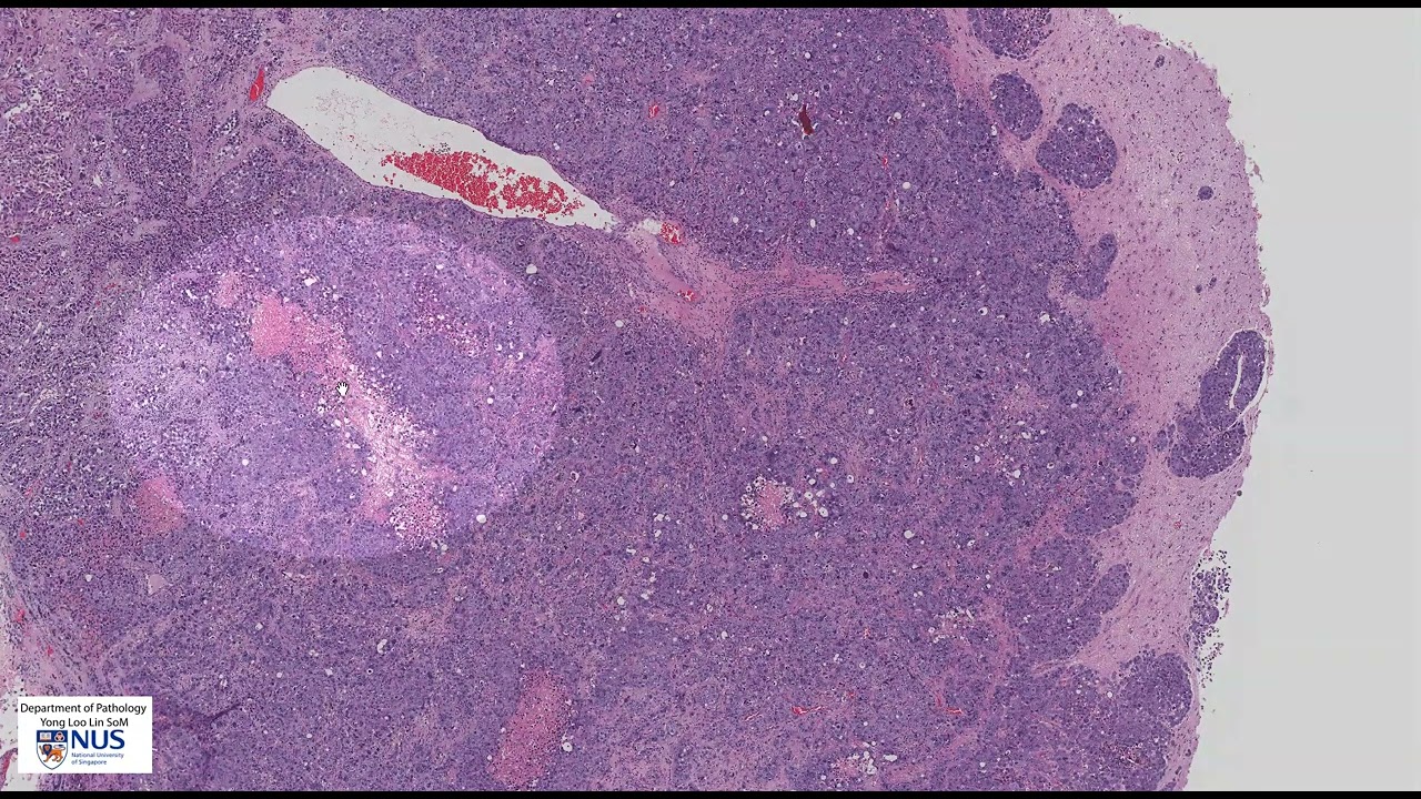 Brain, metastatic breast carcinoma microscopy - Talking slide - YouTube