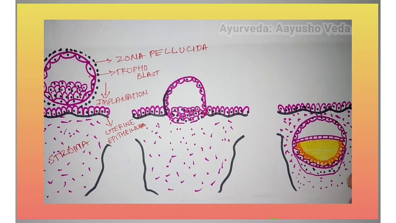 IMPLANTATION: Interstitial implantation - YouTube