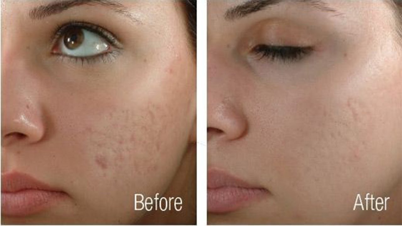 how to get rid of a Pimple (Acne) overnight quickly | 11 Best way ...