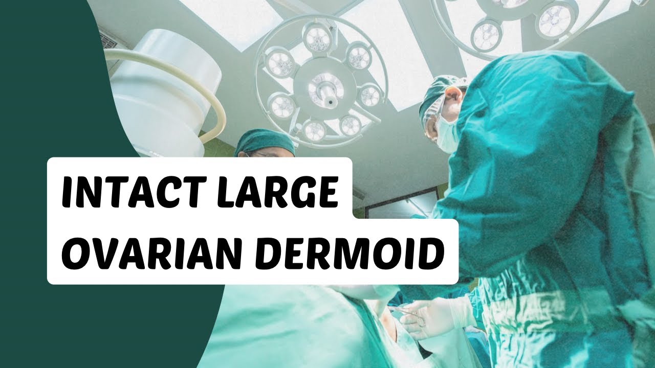 Laparoscopic Dissection of Intact Large (10 cm) Ovarian Dermoid Cyst ...