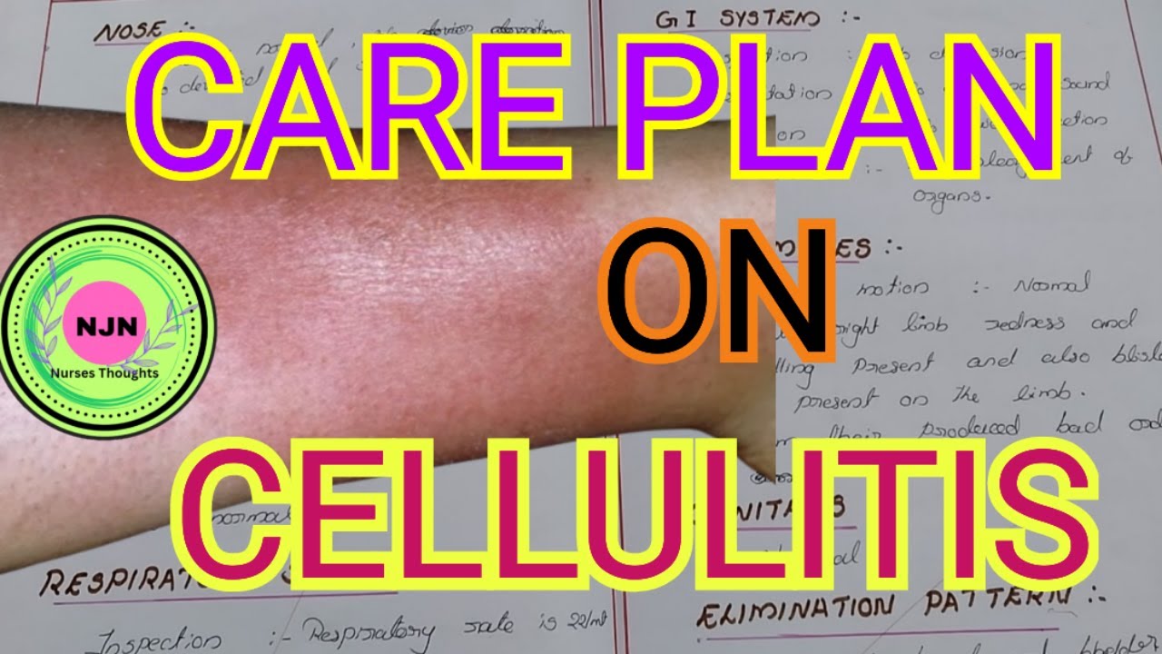 Care Plan On Cellulitis// Medical Surgical Care Plan// Surgical Case //CELLULITIS . - YouTube