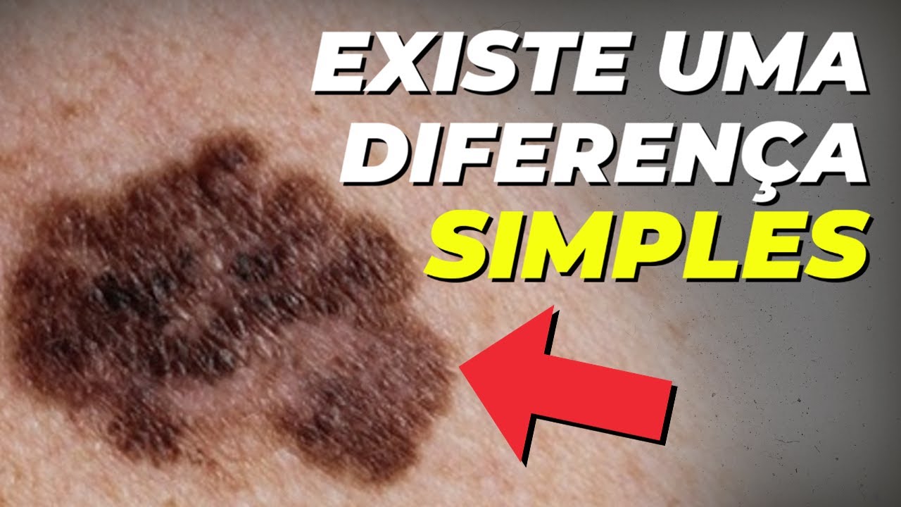 COMO SABER SE UMA PINTA PODE SER CÂNCER DE PELE: APRENDA! - YouTube