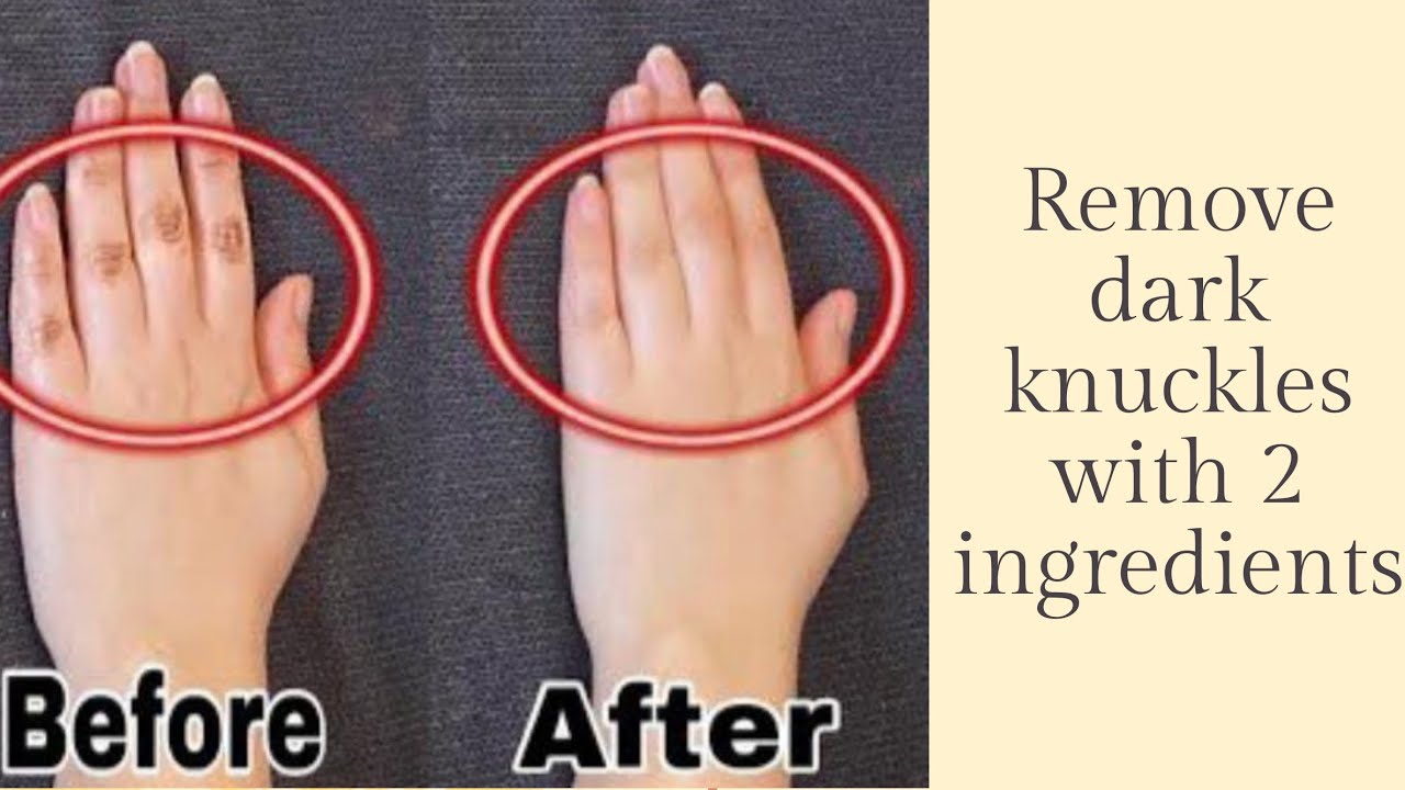 How to get rid of dark knuckles with two ingredients| The Glam Guide ...