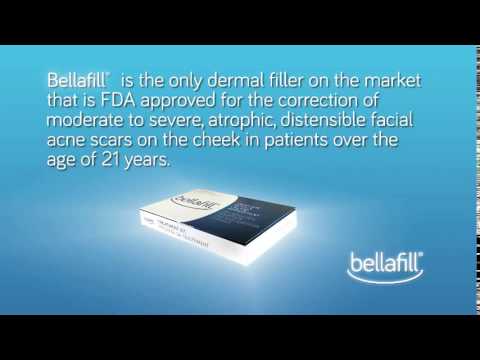Bellafill® Now Approved for Acne Scar Correction - YouTube