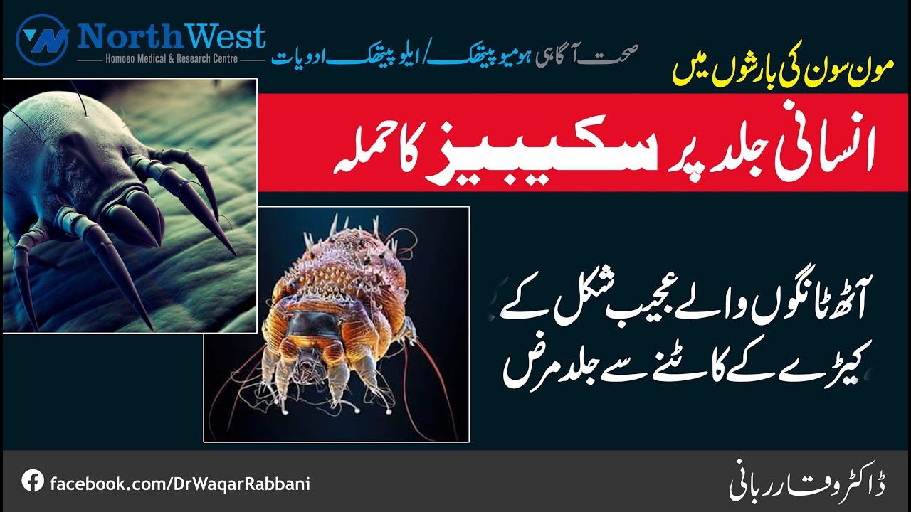 Kharish Khatam Karne Ka Tarika | Scabies Ka Ilaj in Urdu | Itching ...