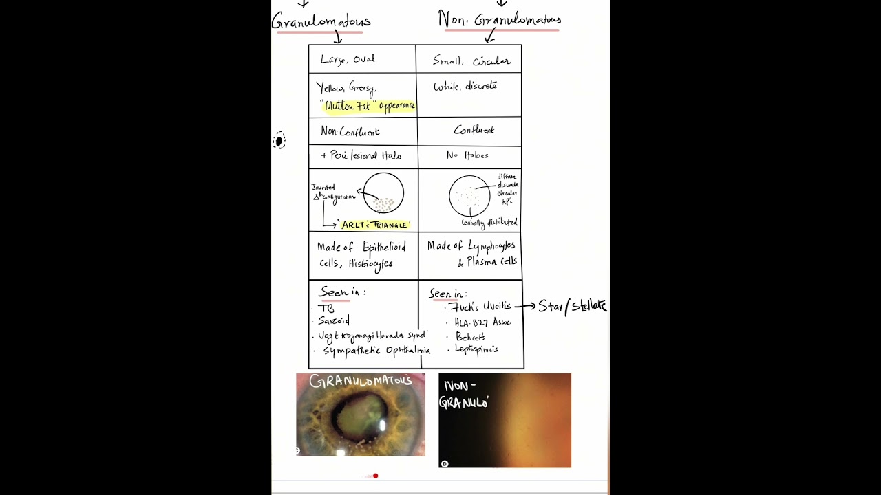 Granulomatous Keratic Precipitates