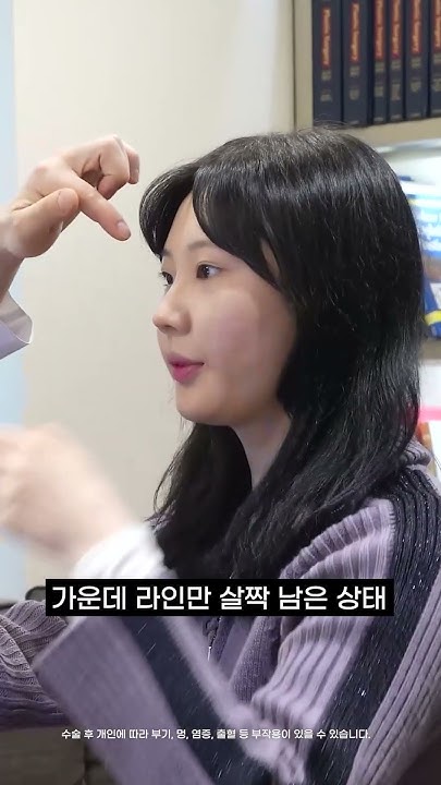 풀린 쌍수 재수술 전후 Shorts Youtube