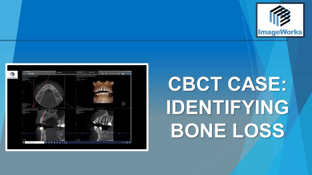 CBCT Case: Identifying bone loss - YouTube