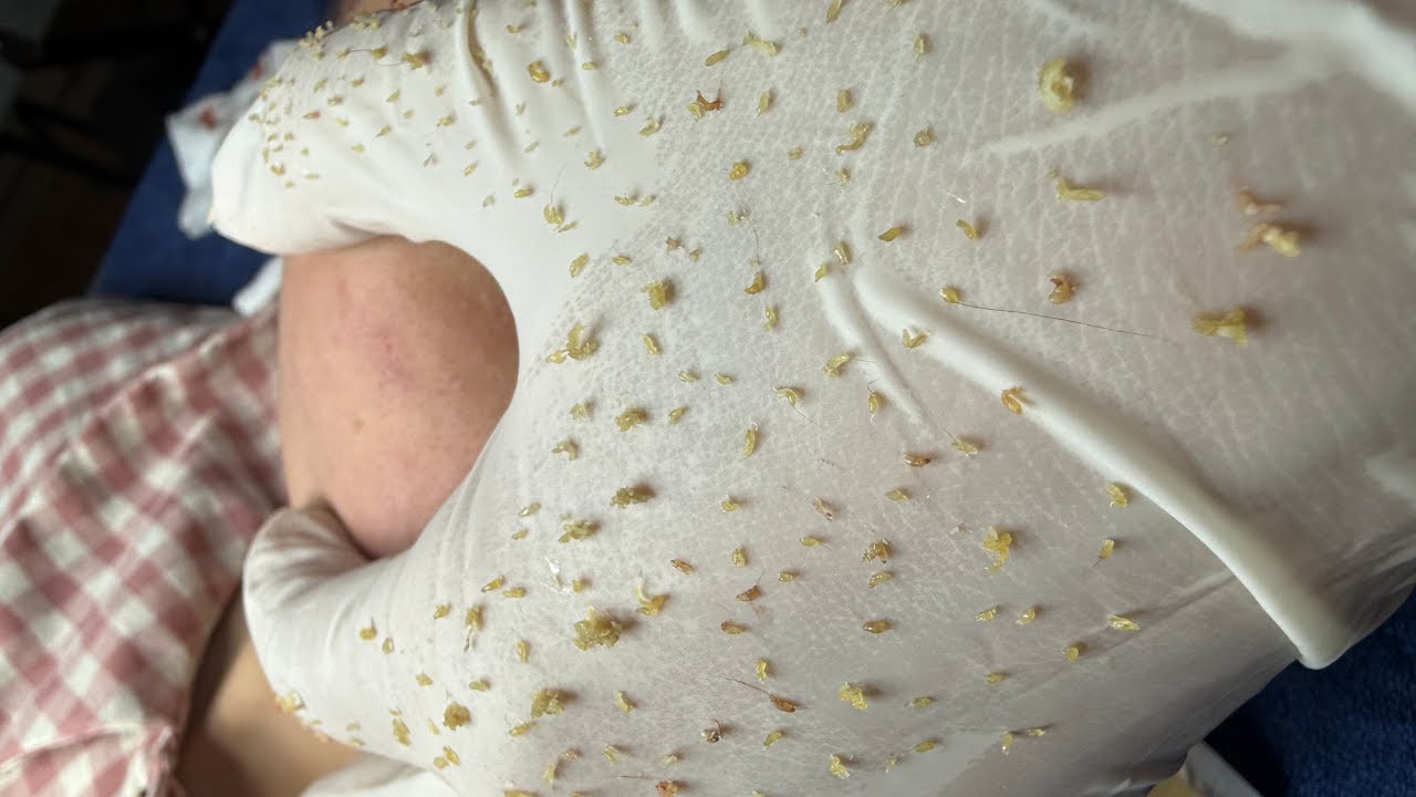Remove Deeply Embedded Blackheads Beneath The Skin. - YouTube