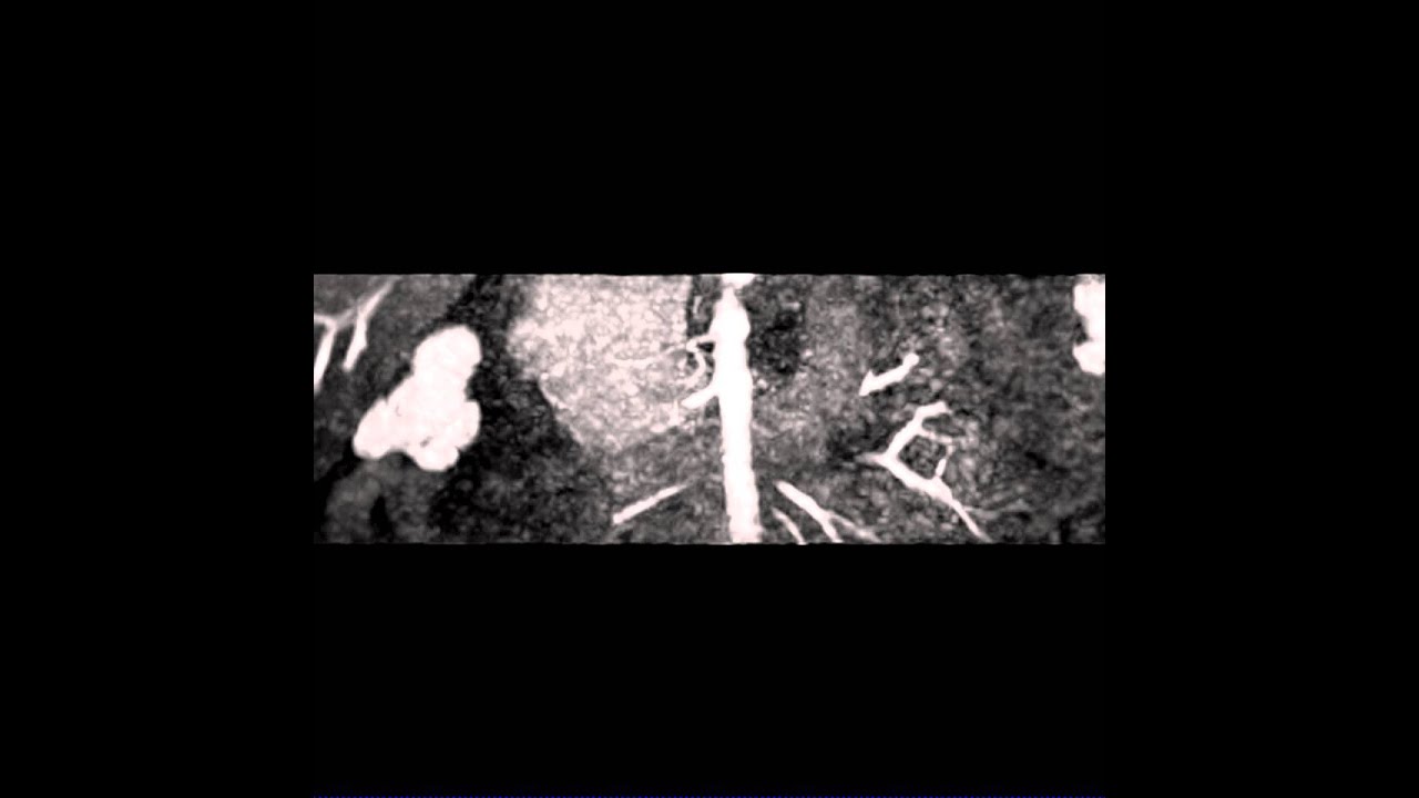 Non Contrast MRI Renal Angio - YouTube