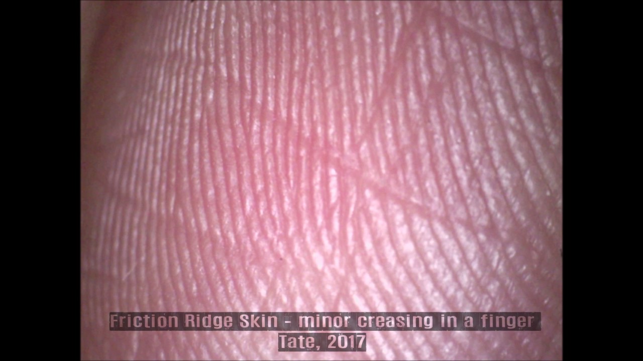 minor creasing in the friction ridge skin - YouTube