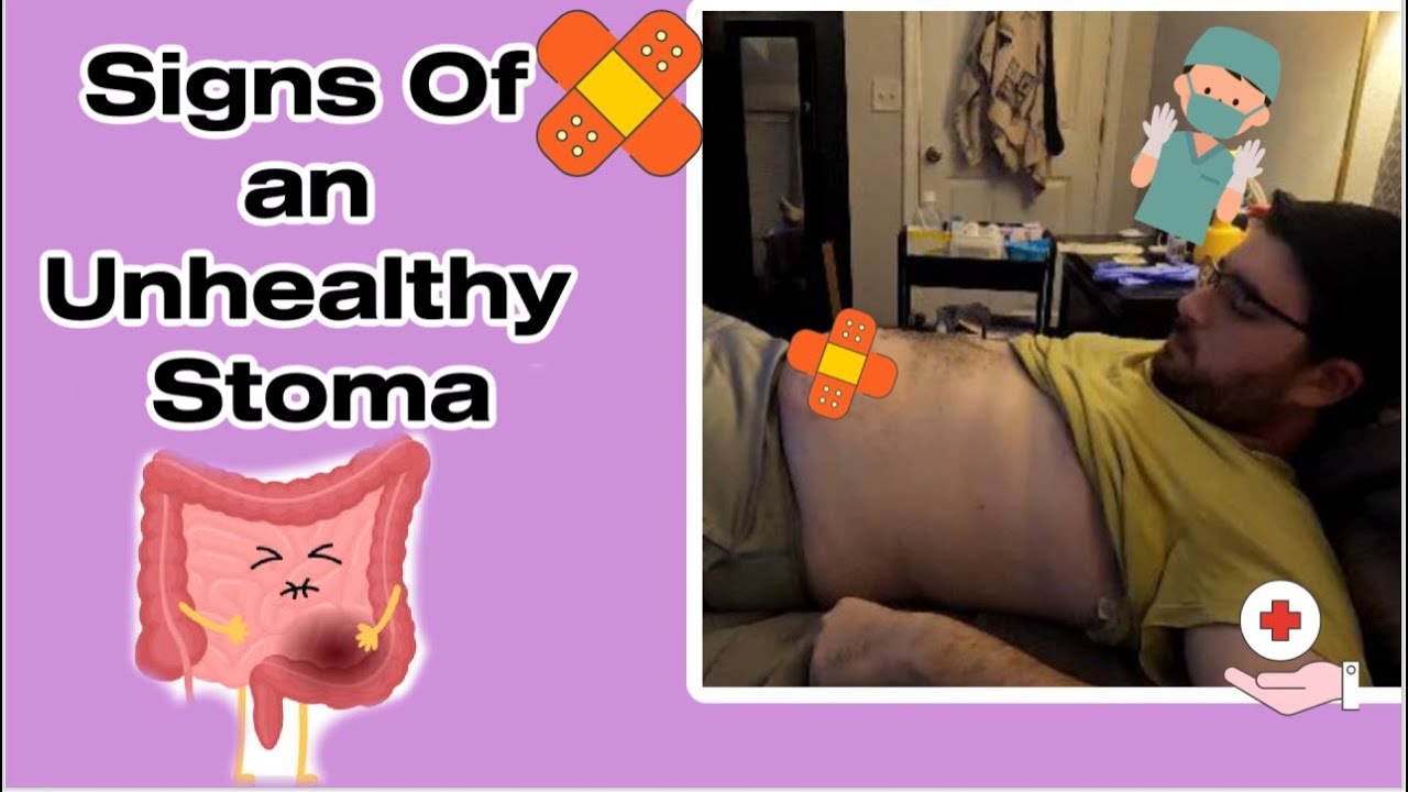 Ulcers On My Stoma🦠 Crohns Disease Fighting Back🤜 Youtube