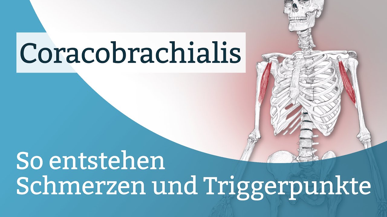 Coracobrachialis Schmerzen, Triggerpunkte und deren Aktivierung - YouTube