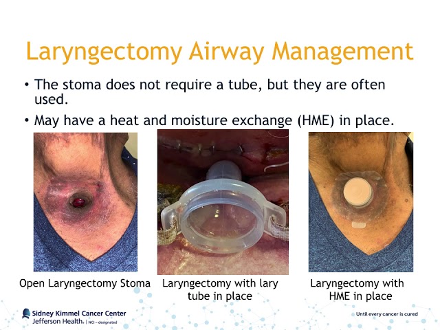 Total Laryngectomy Stoma