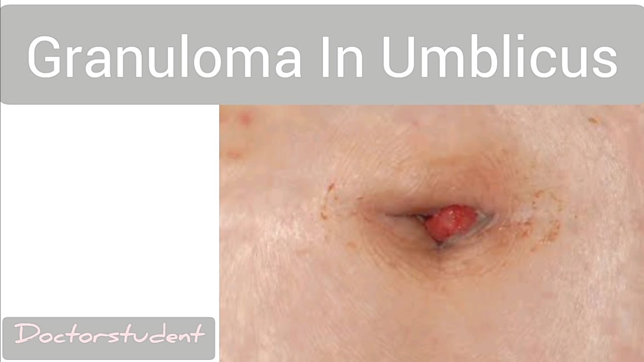 Granuloma of umbilicus in infants - YouTube