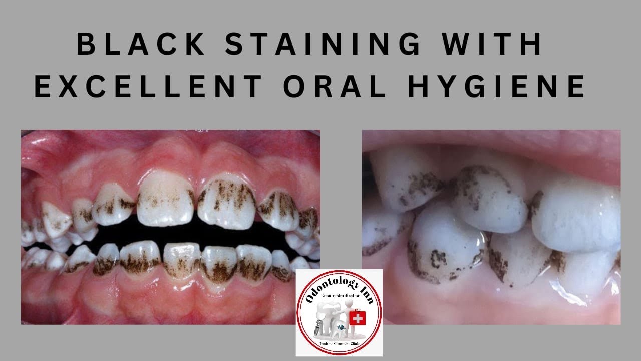 BLACK STAINING IN TEETH DESPITE GOOD BRUSHING | CHROMOGENIC BLACK ...