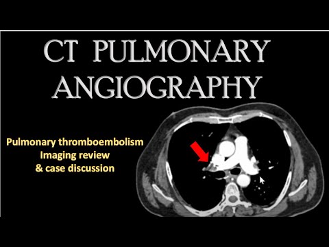 CT PULMONARY ANGIOGRAPHY |PULMONARY THROMBOEMBOLISM| Pulmonary vessels ...
