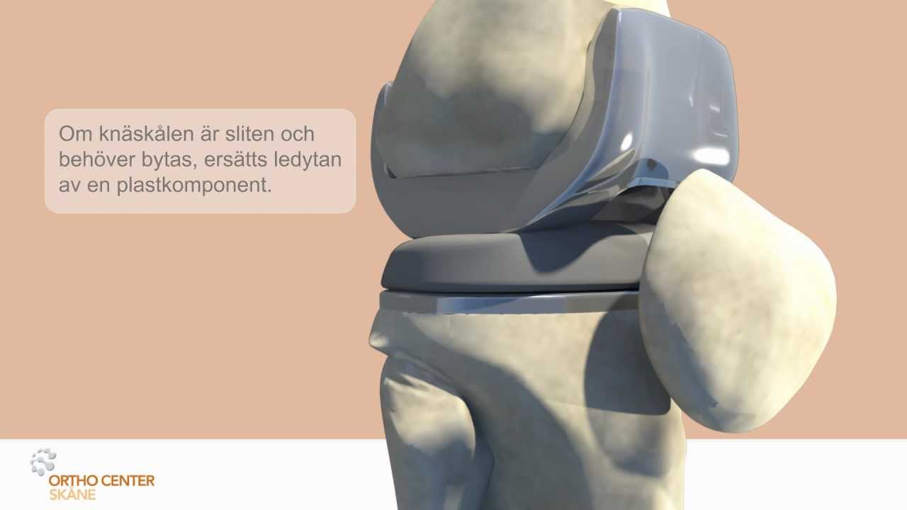 Knäledsplastik Ortho Center Skåne - YouTube