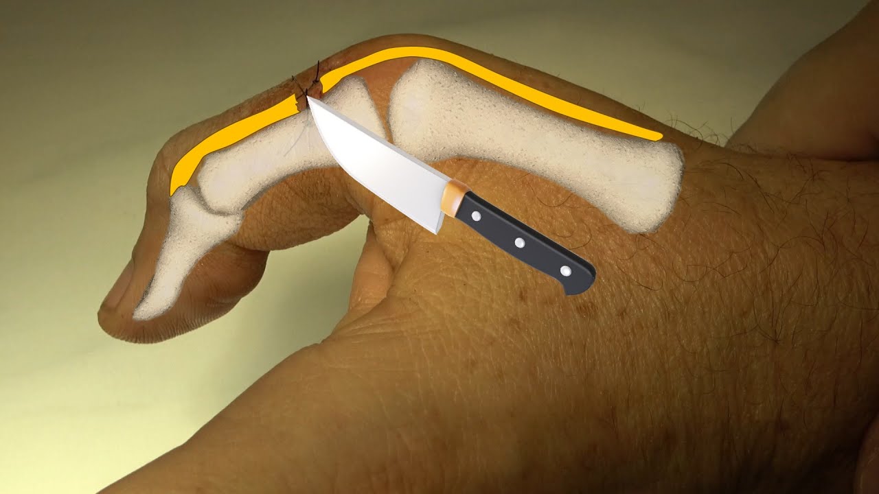 Extensor pollicis longus lesion: Primary repair - YouTube