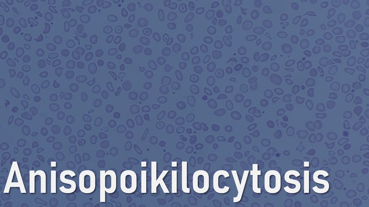 Red cells: Anisopoikilocytosis - YouTube