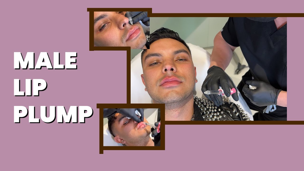 FILLER FRIDAY MAGNIFICENT MALE LIP PLUMP | Dr. Jason Emer - YouTube