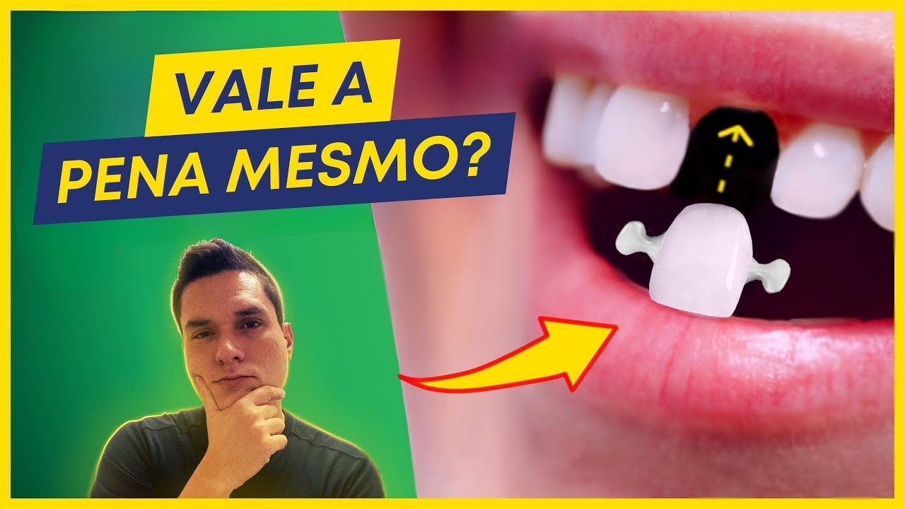 PRÓTESE ADESIVA X IMPLANTE DENTÁRIO: VANTAGENS E DESVANTAGENS! - YouTube