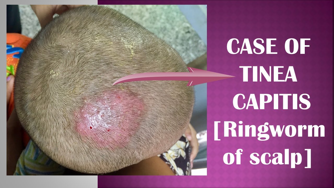 Case Study II Tinea Capitis II Ringworm of Scalp - YouTube
