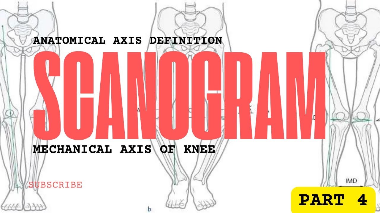 Deformity Correction: anatomical and mechanical axis – (scanogram ) - YouTube