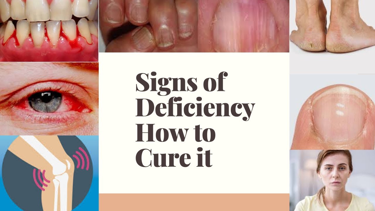 SIGNS OF NUTRIENTS DEFICIENT BODY- HOW TO CURE IT - YouTube