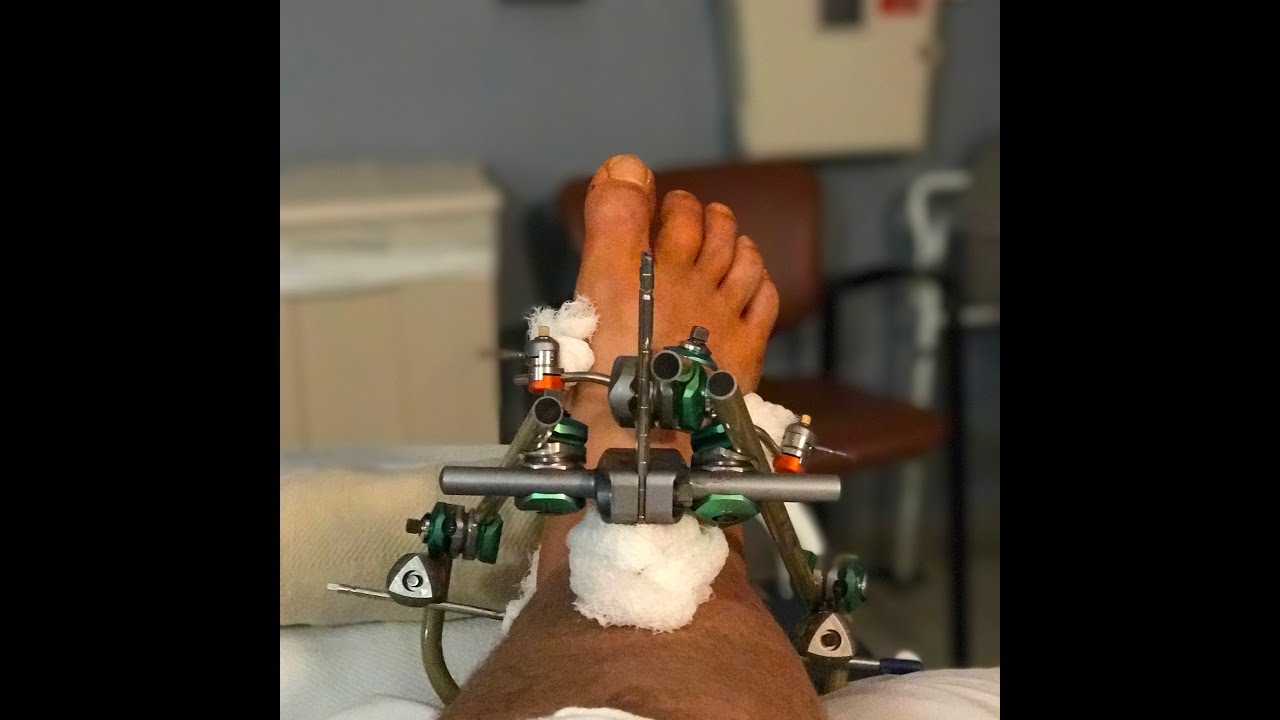 Broke Both Ankles Youtube