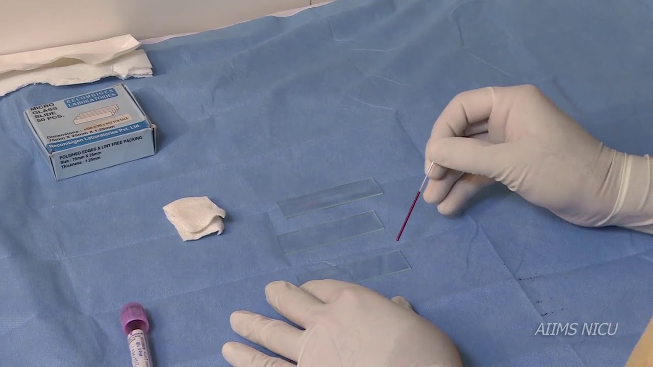 How to prepare peripheral smear? - YouTube