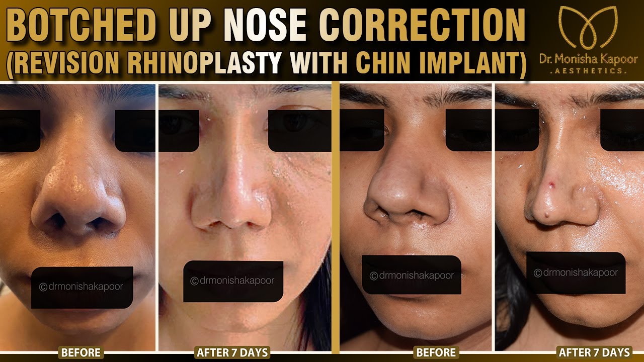 Botched Up Nose Correction | Revision Rhinoplasty with Chin Implant ...