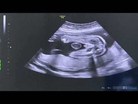 Usg Baby Zafki ( 23 Weeks ) Baby Boy - YouTube