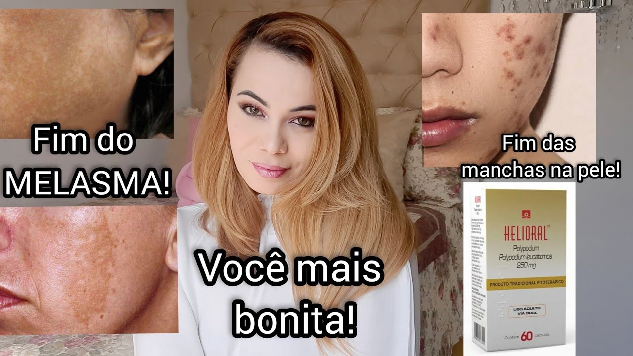 Helioral - Fim do melasma e das manchas na pele - YouTube