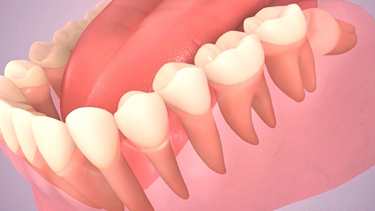 Wisdom Tooth Crowding - YouTube