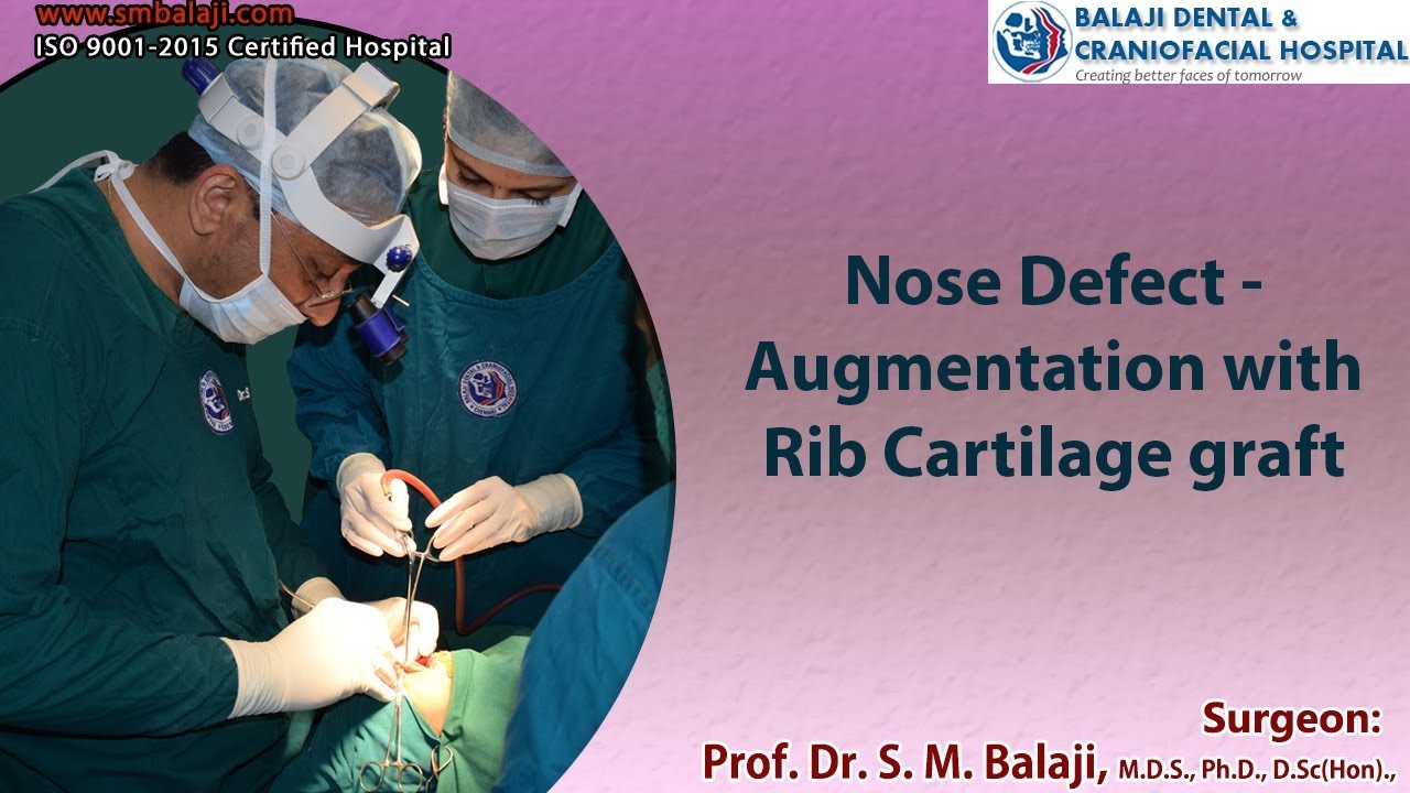 Nose Defect - Augmentation with Rib Cartilage graft - YouTube