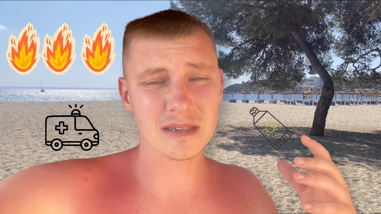 My Sunburn Disaster In Mallorca! 😱 - YouTube