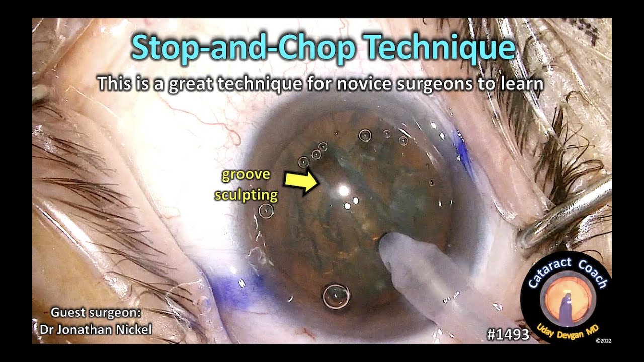 CataractCoach 1493: stop and chop phaco technique - YouTube