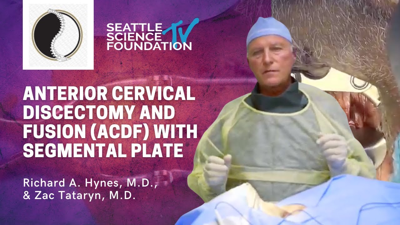Anterior Cervical Discectomy and Fusion with Segmental Plate- Richard A ...