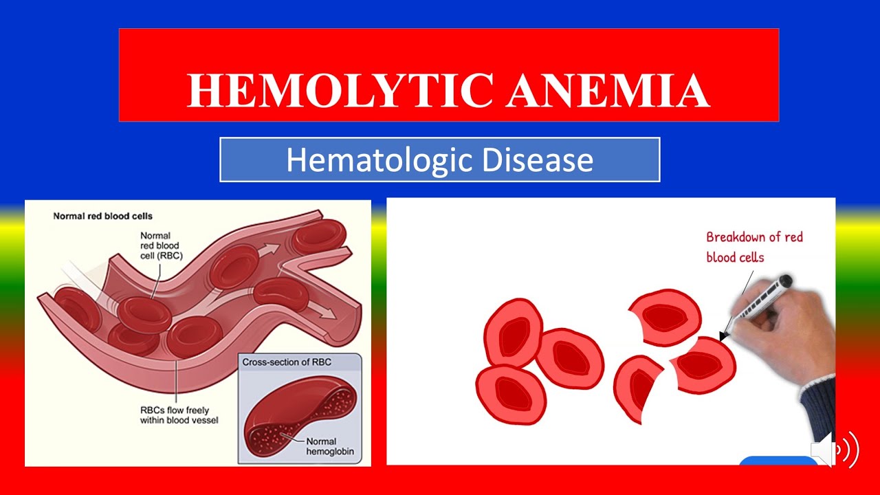 HEMOLYTIC ANEMIA - Definition, types, cusses, pathophysiology, signs ...
