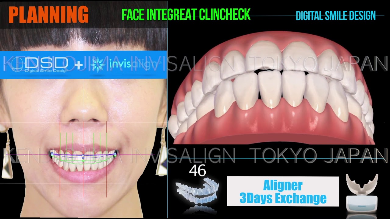 Invisalign Accelerate Approach for Aligner Orthodontics 【3Days Aligner ...