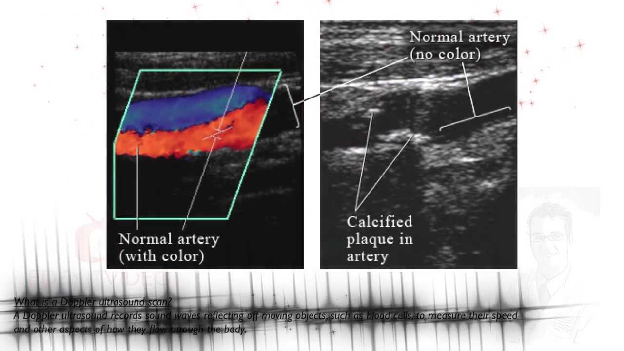 doppler ultrasound - YouTube
