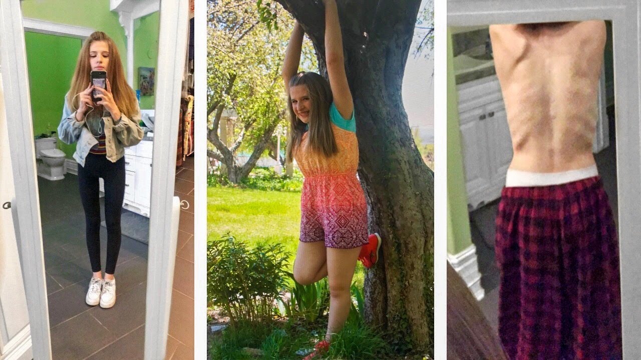 My Eating Disorder Story (anorexia nervosa) - YouTube