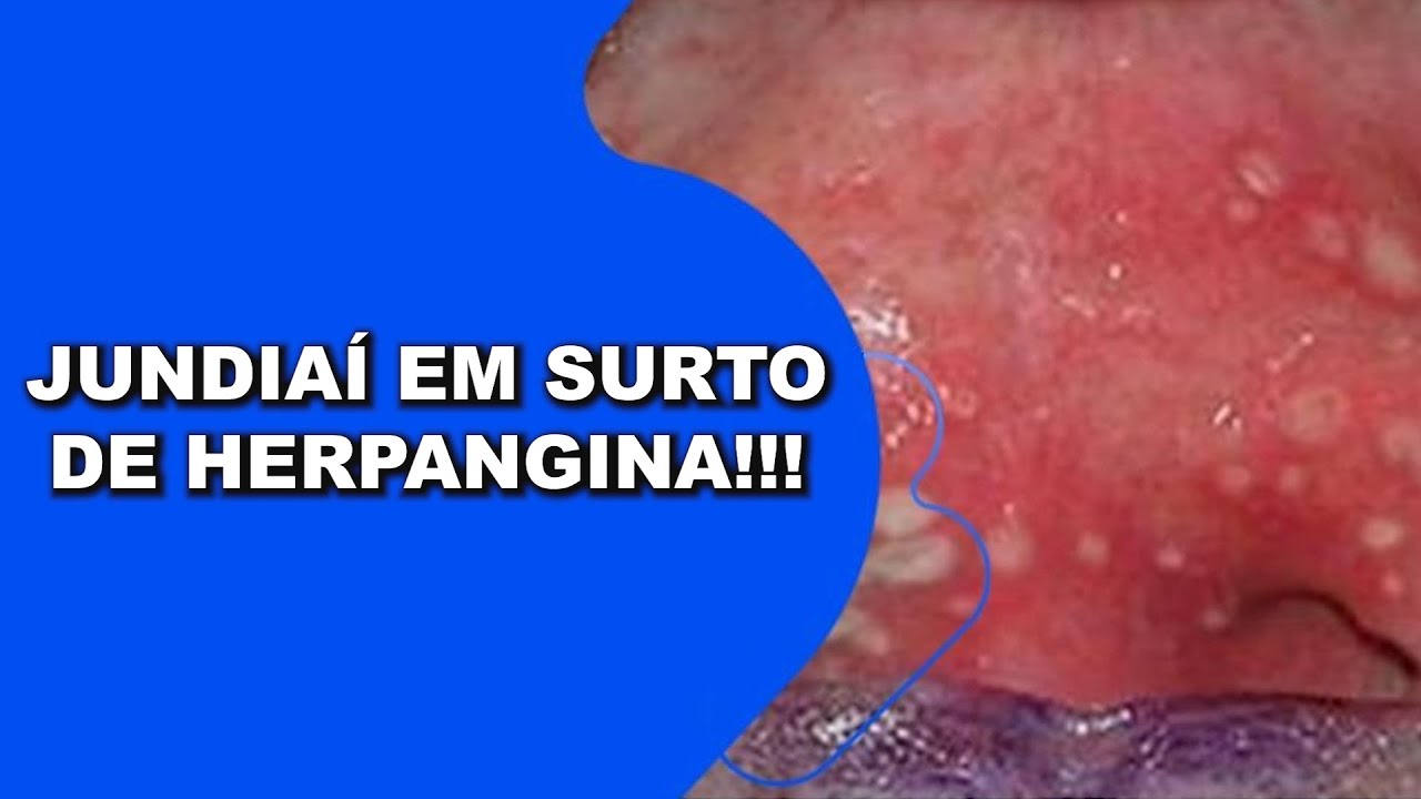 JundiaÍ Em Surto De Herpangina Youtube