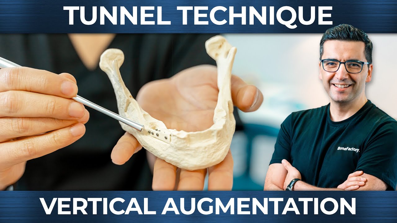 🇺🇸 TUNNEL TECHNIQUE: SAFE approach for VERTICAL AUGMENTATION 🇬🇧/🇩🇪 ...