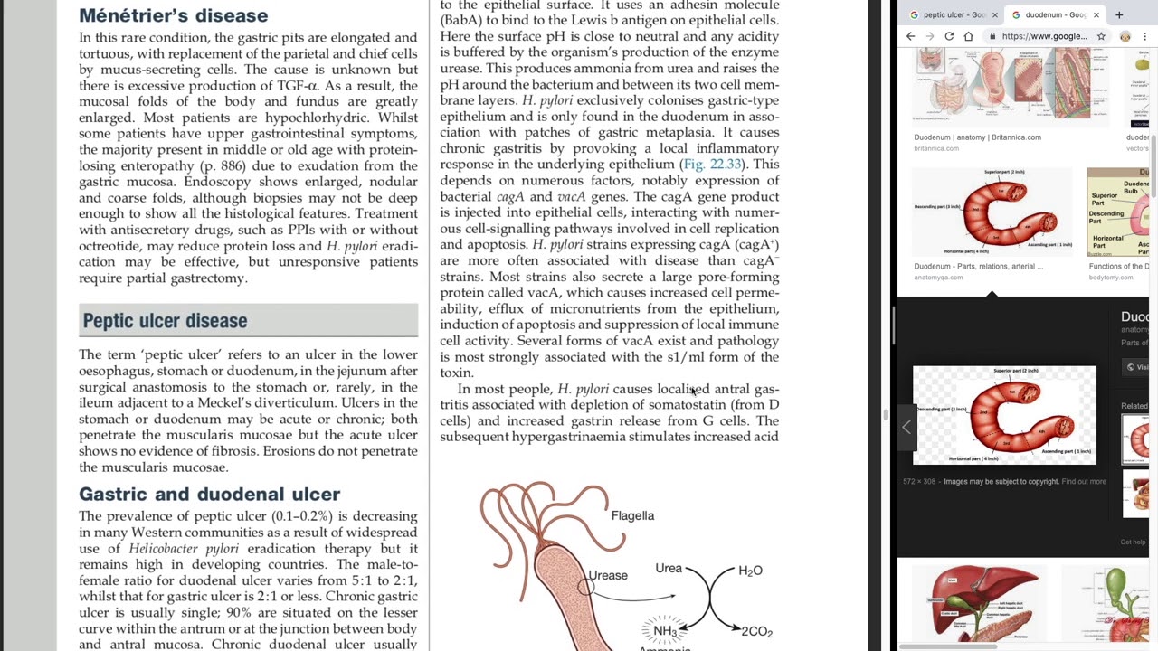 Gastritis and Peptic ulcer (Part 2 - Peptic ulcer) | Thomas dissects ...