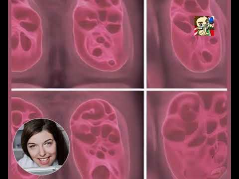 Modelo YOLO para detección de cáncer: A Yolo Based Model for Breast ...