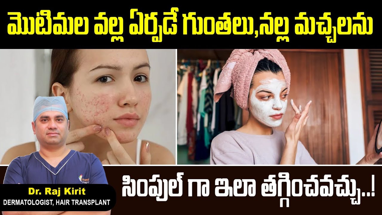 Best Treatment for Acne Scars and Open Pores || Causes Of Hormonal Acne ...