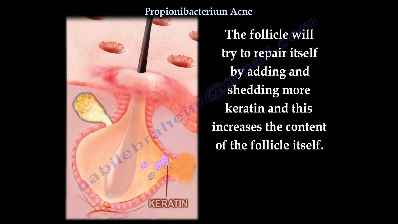 Acne explained ,Propionibacterium Acne - Everything You Need To Know ...