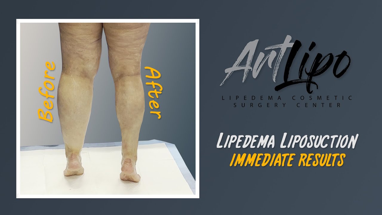 Lipedema Leg Liposuction | Cankles & Knees Complex | Expert Dr. Thomas ...